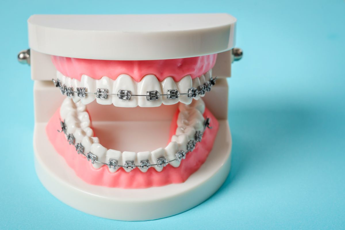 How long does it take for teeth to start moving with braces ...